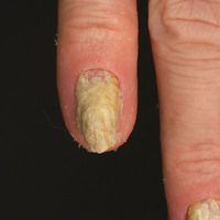 Psoriasis of the nails Bilder - Altmeyers Enzyklopädie - Fachbereich ...