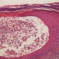 Psoriasis pustulosa palmaris et plantaris Images - Altmeyers ...