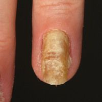 Psoriasis of the nails Bilder - Altmeyers Enzyklopädie - Fachbereich ...