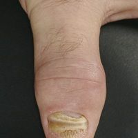 Psoriasis der Nägel Images - Altmeyers Encyclopedia - Department ...