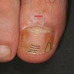 Beau-reilsche cross furrows of the nails - Altmeyers Encyclopedia ...