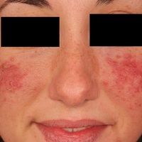 Rosacea papulopustulosa Images - Altmeyers Encyclopedia - Department ...