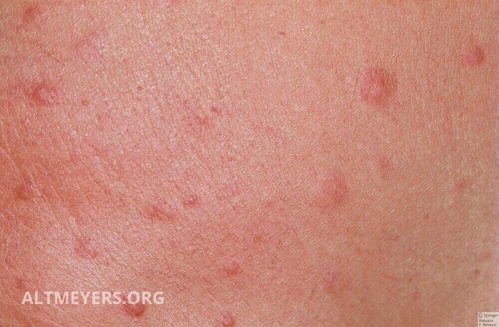 Cholinergic Urticaria Mild