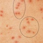 Flohstich - Altmeyers Enzyklopädie - Fachbereich Dermatologie