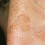 Lentigo simplex - Altmeyers Encyclopedia - Department Dermatology