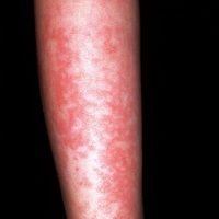 Erythema infectiosum Bilder - Altmeyers Enzyklopädie - Fachbereich ...