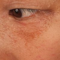 Syringom (Übersicht) Bilder - Altmeyers Enzyklopädie - Fachbereich ...