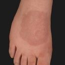 Rodnan skin score - Altmeyers Encyclopedia - Department Dermatology