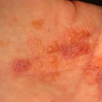 Cheiropompholyx Images - Altmeyers Encyclopedia - Department Dermatology