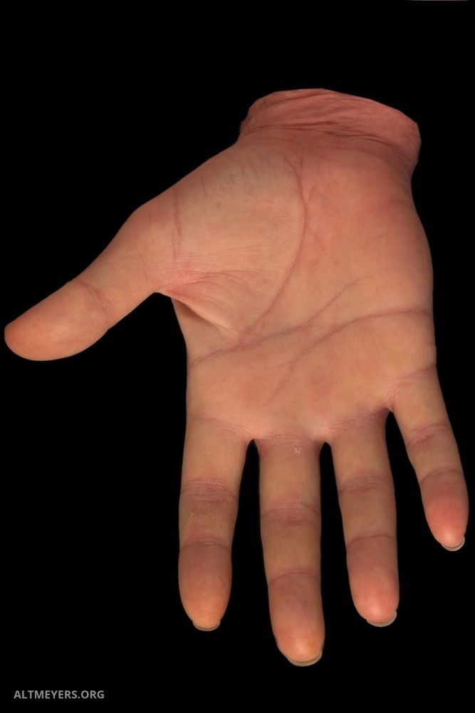 Doughnut Sign Scleromyxedema