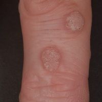 Verruca vulgaris Images - Altmeyers Encyclopedia - Department Dermatology