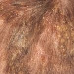 Pityriasis amiantacea - Altmeyers Enzyklopädie - Fachbereich Dermatologie