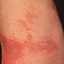Atopic diathesis - Altmeyers Encyclopedia - Department Dermatology