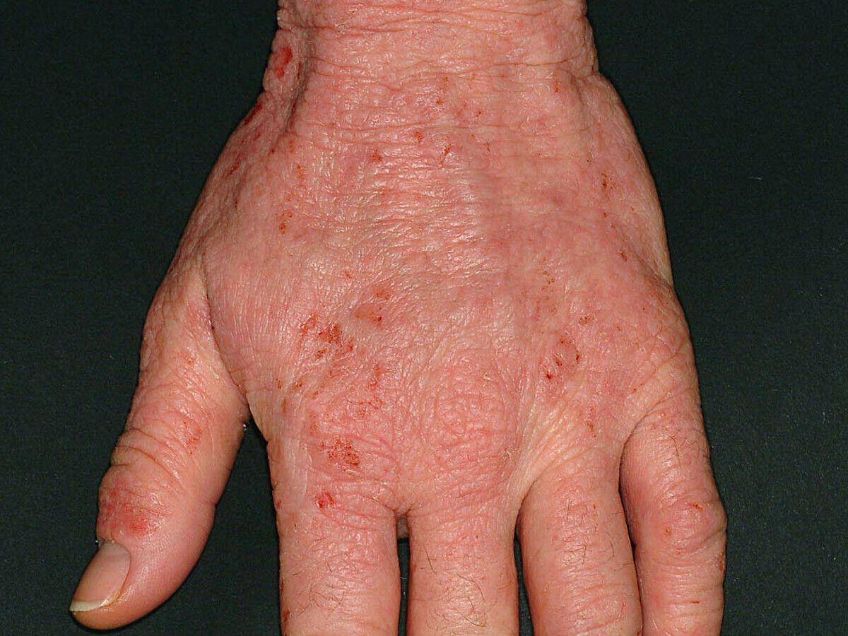 Atopic Dermatitis On Hands