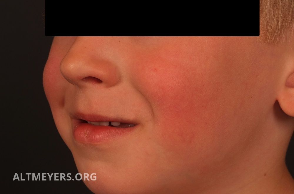 Fifth Disease Face