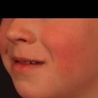 Erythema infectiosum Bilder - Altmeyers Enzyklopädie - Fachbereich ...