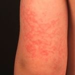 Erythema infectiosum - Altmeyers Enzyklopädie - Fachbereich Dermatologie