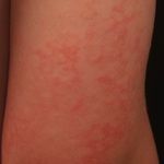 Erythema infectiosum - Altmeyers Enzyklopädie - Fachbereich Dermatologie