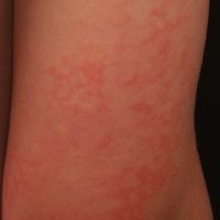 Erythema infectiosum Bilder - Altmeyers Enzyklopädie - Fachbereich ...