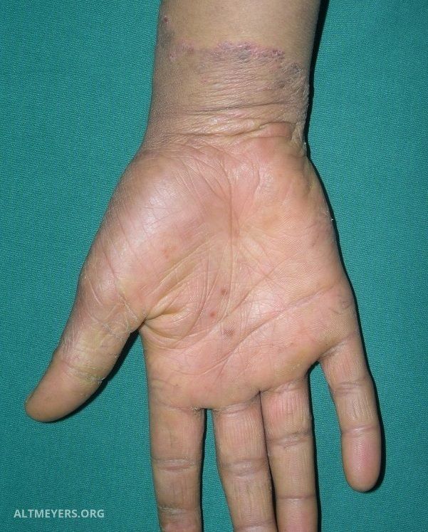 Tinea Manuum