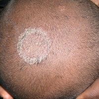 Tinea capitis (overview) Images - Altmeyers Encyclopedia - Department ...