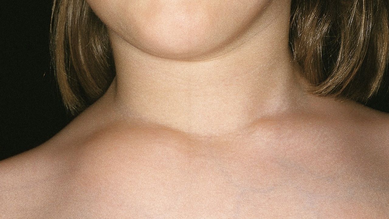 Cavernous Lymphangioma