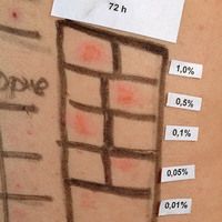 Epicutaneous test Images - Altmeyers Encyclopedia - Department Allergology