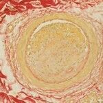 Livedo racemosa - Altmeyers Encyclopedia - Department Vascular medicine