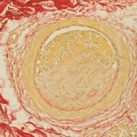 Livedo racemosa Bilder - Altmeyers Enzyklopädie - Fachbereich Gefäßmedizin