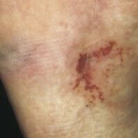 Livedo racemosa Images - Altmeyers Encyclopedia - Department Vascular ...