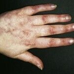 Livedo racemosa - Altmeyers Encyclopedia - Department Vascular medicine