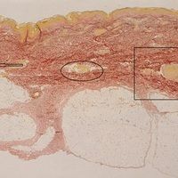 Livedo racemosa Images - Altmeyers Encyclopedia - Department Vascular ...