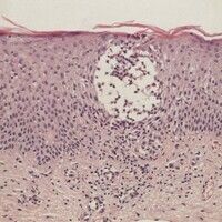 Dermatitis kontaktallergische Images - Altmeyers Encyclopedia ...