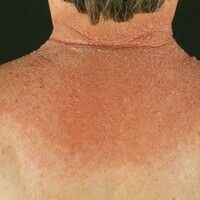 Photoallergic dermatitis Images - Altmeyers Encyclopedia - Department ...