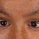 Ectropium - Altmeyers Encyclopedia - Department Dermatology