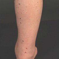 Melanoma cutaneous Images - Altmeyers Encyclopedia - Department Dermatology