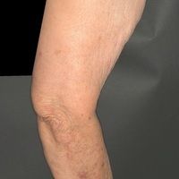 Brachioradial pruritus Images - Altmeyers Encyclopedia - Department ...