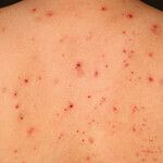 Prurigo gestationis - Altmeyers Enzyklopädie - Fachbereich Dermatologie