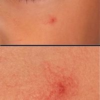 Nevus araneus Bilder - Altmeyers Enzyklopädie - Fachbereich Gefäßmedizin