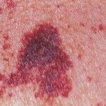 Purpura senilis - Altmeyers Encyclopedia - Department Vascular medicine