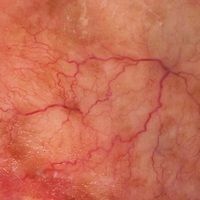 Teleangiectasia Images - Altmeyers Encyclopedia - Department Vascular ...