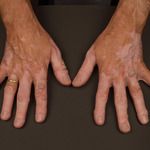 Generalized verrucosis - Altmeyers Encyclopedia - Department Dermatology