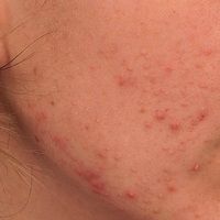 Acne papulopustulosa Images - Altmeyers Encyclopedia - Department ...