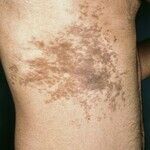 Becker Naevus - Altmeyers Enzyklopädie - Fachbereich Dermatologie