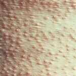 Follicular mucinosis - Altmeyers Encyclopedia - Department Dermatology
