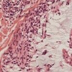 Follicular mucinosis - Altmeyers Encyclopedia - Department Dermatology