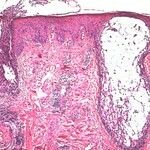 Follicular mucinosis - Altmeyers Encyclopedia - Department Dermatology