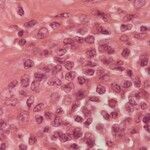 Mycosis fungoides (Übersicht) - Altmeyers Enzyklopädie - Fachbereich ...