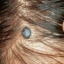 Blue nevus, malignant - Altmeyers Encyclopedia - Department Dermatology