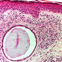 Miliaria Bilder - Altmeyers Enzyklopädie - Fachbereich Dermatologie